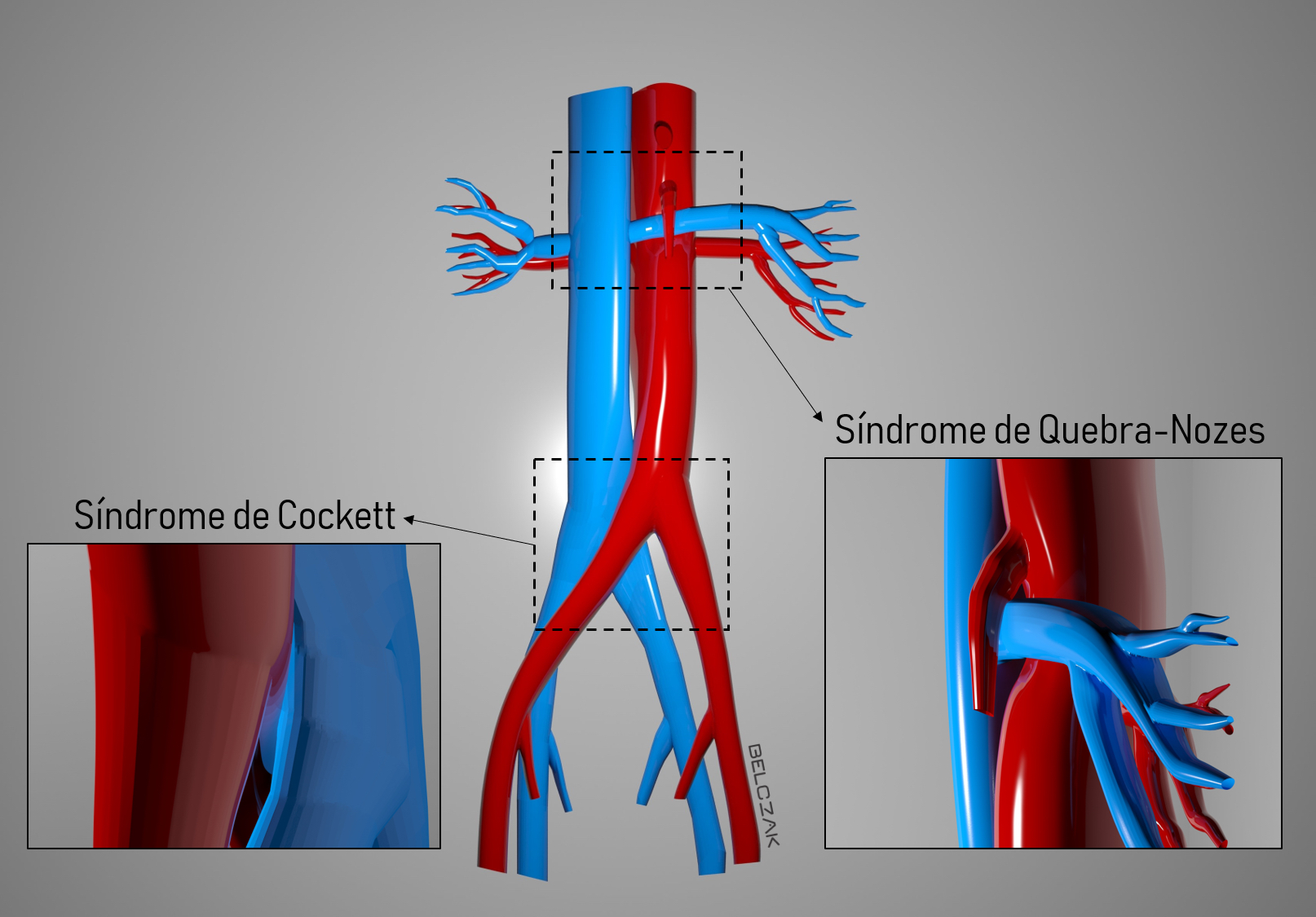 Síndromes Compressivas Venosas - Instituto Belczak